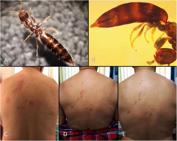 Dermatite e Scleroderma Domesticum Disinfestazione Scleroderma ...