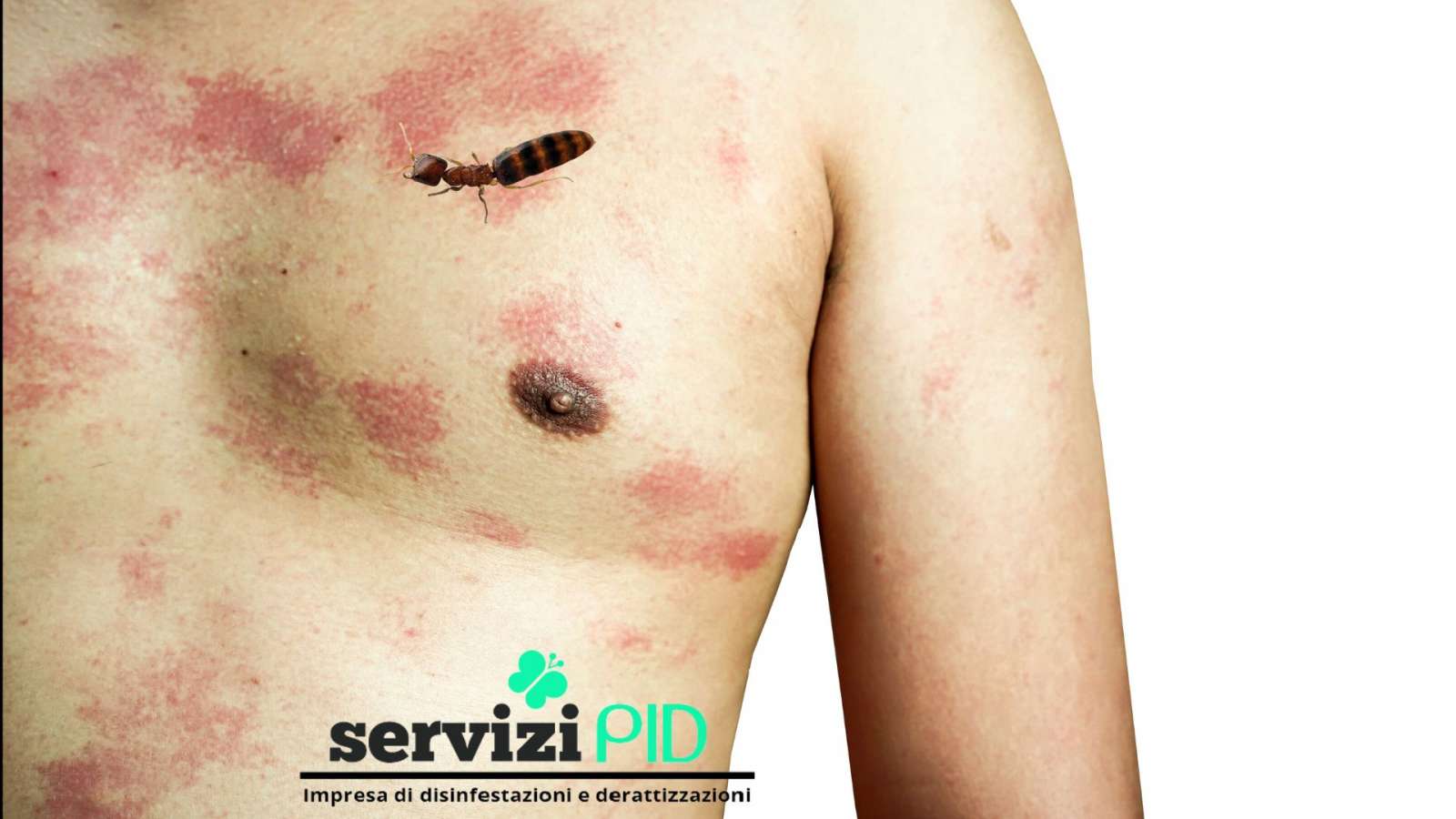 Dermatite e Scleroderma Domesticum Disinfestazione Scleroderma ...